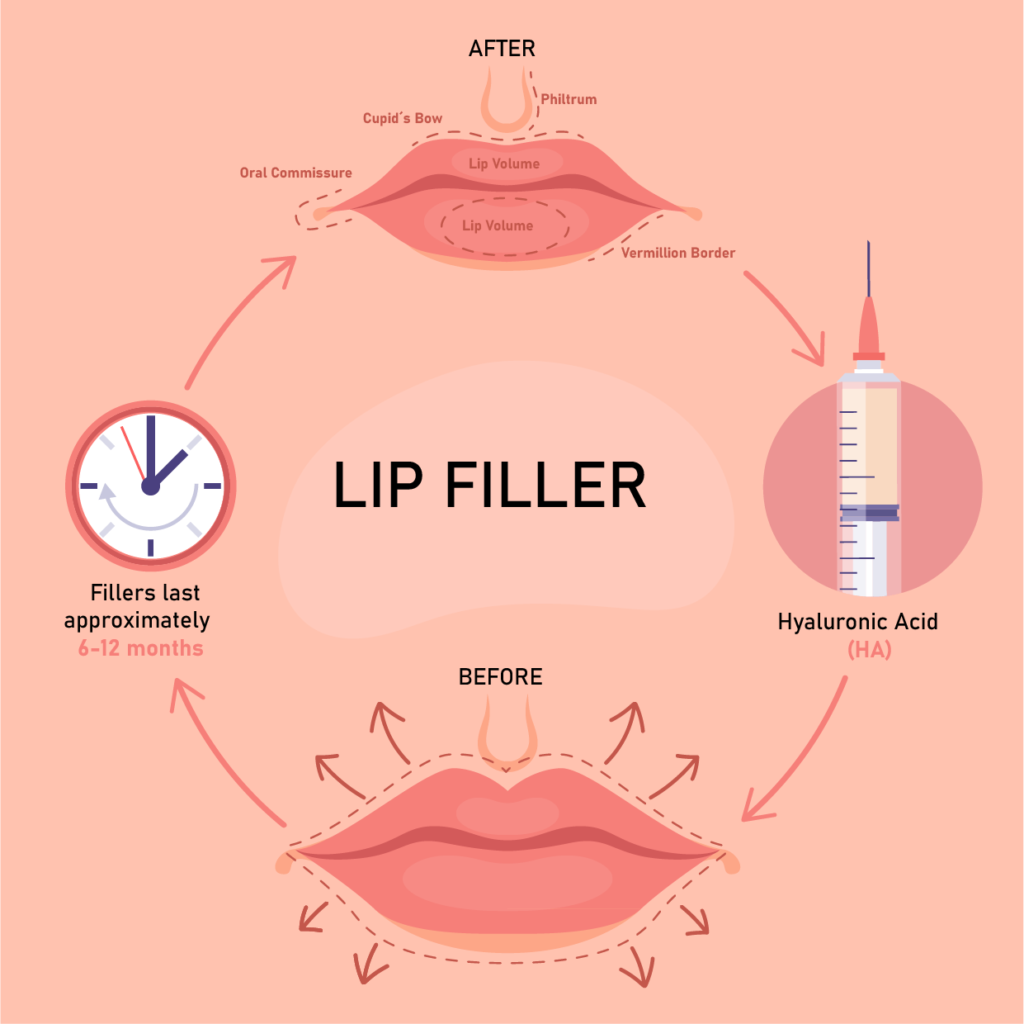 Lip Filler Before and After Guide: See the Difference – ᗪᗩIᒪY ᗰᗩKEᑌᑭ TIᑭ